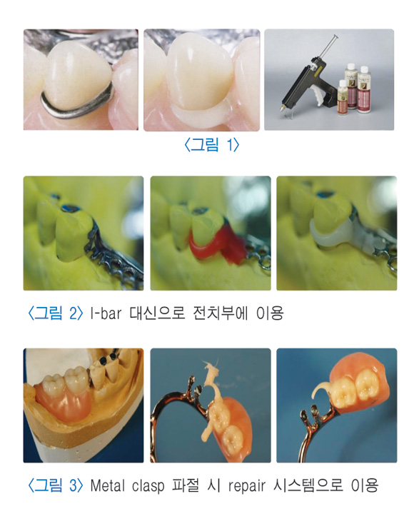 Metal clasp 대신으로 사용되는 natural acetel clasp