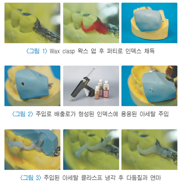 I bar clasp 대신으로 전치부에 이용되는 acetel natural clasp