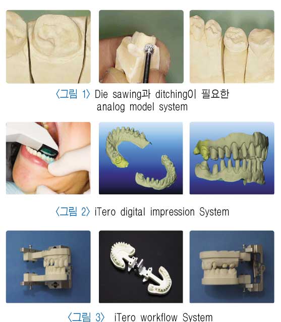 Die sawing과 ditching이 불필요한 iTero Digital impression & Workflow-⑦