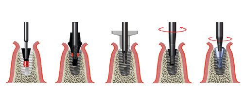 “실패된 임플란트 Help Kit이 돕는다”