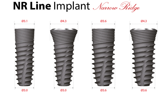 좁은 전치부 Ridge도 쉽게