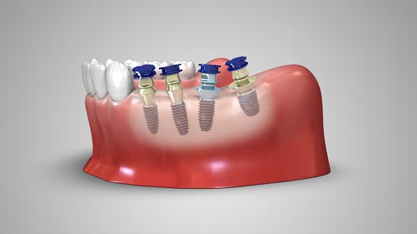 네오, ‘PickCap Impression Coping’ 적용 제품 확대