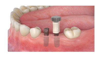 오스템, ‘디지털 상부’ 토탈 라인업 완성